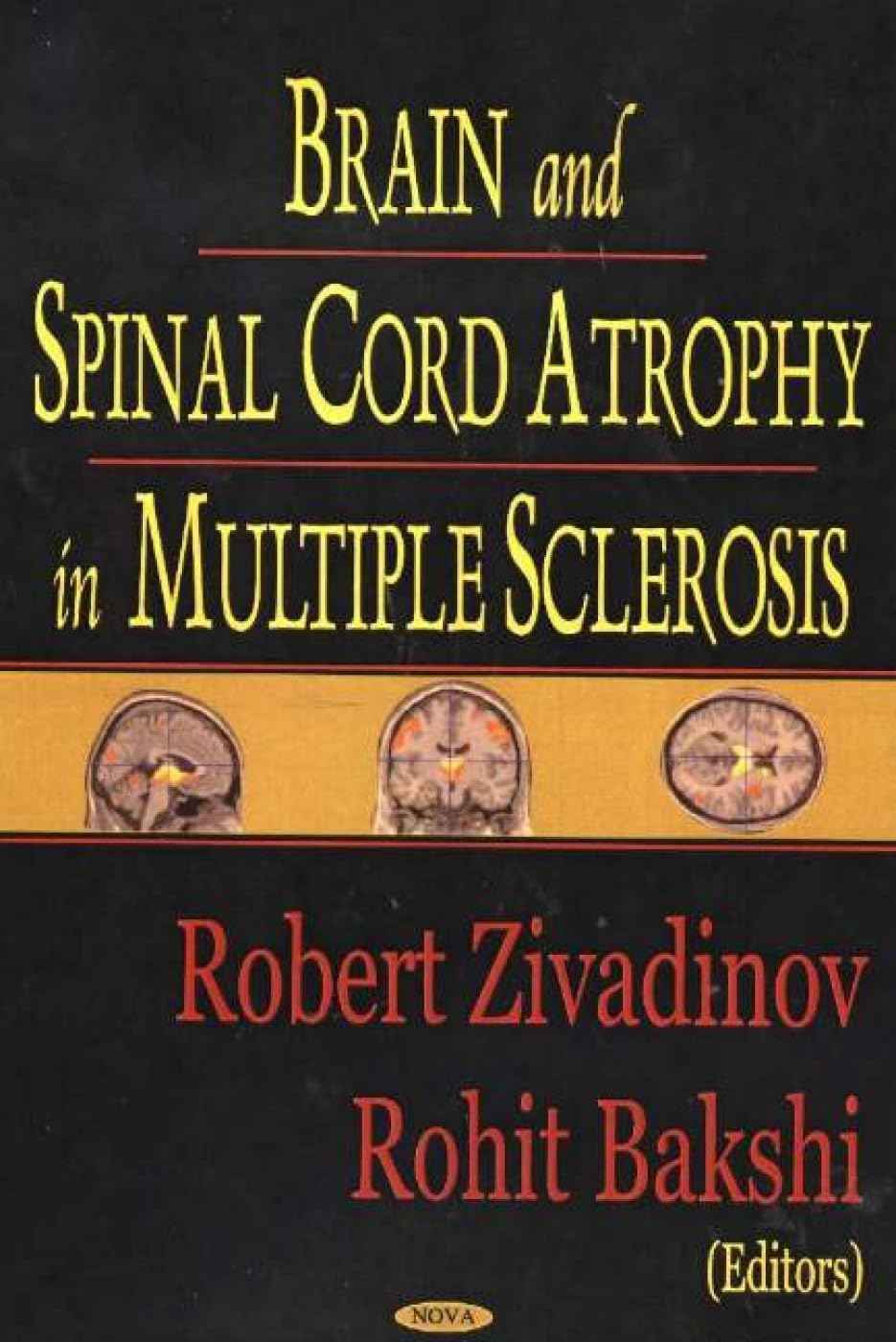 Brain And Spinal Cord Atrophy In Multiple Sclerosis: 9781594541605 ...