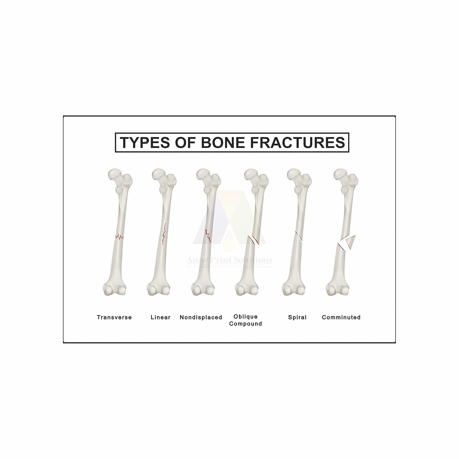 Anne Print Solutions® Types of bone fracture poster (Without Frame) For ...
