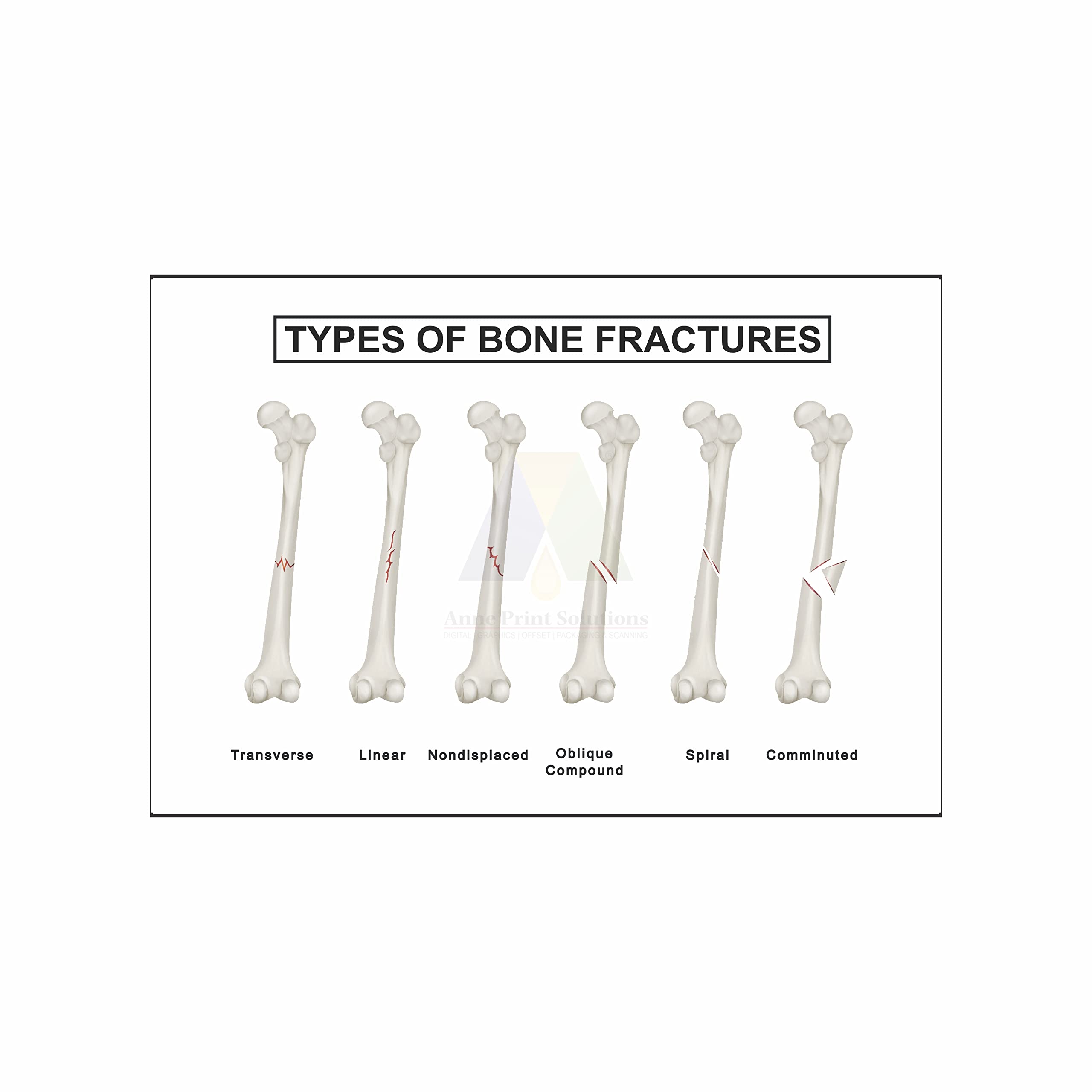 Buy Anne Print Solutions® Types of fracture (Without Frame) For ...