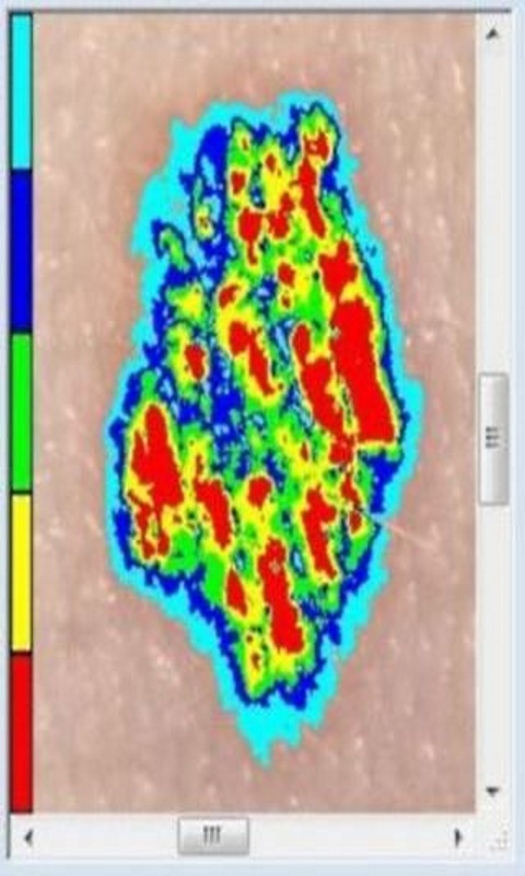 Skin Mole Analysis - App on the Amazon Appstore