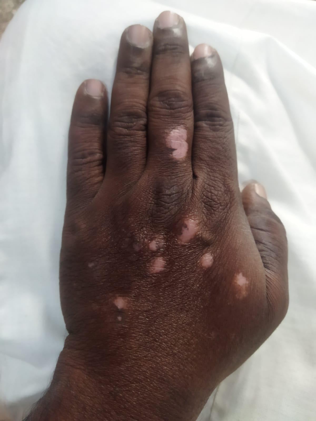 Buy Lecor & Livcon Capsule, For Vitiligo, White Patches Online at Low ...