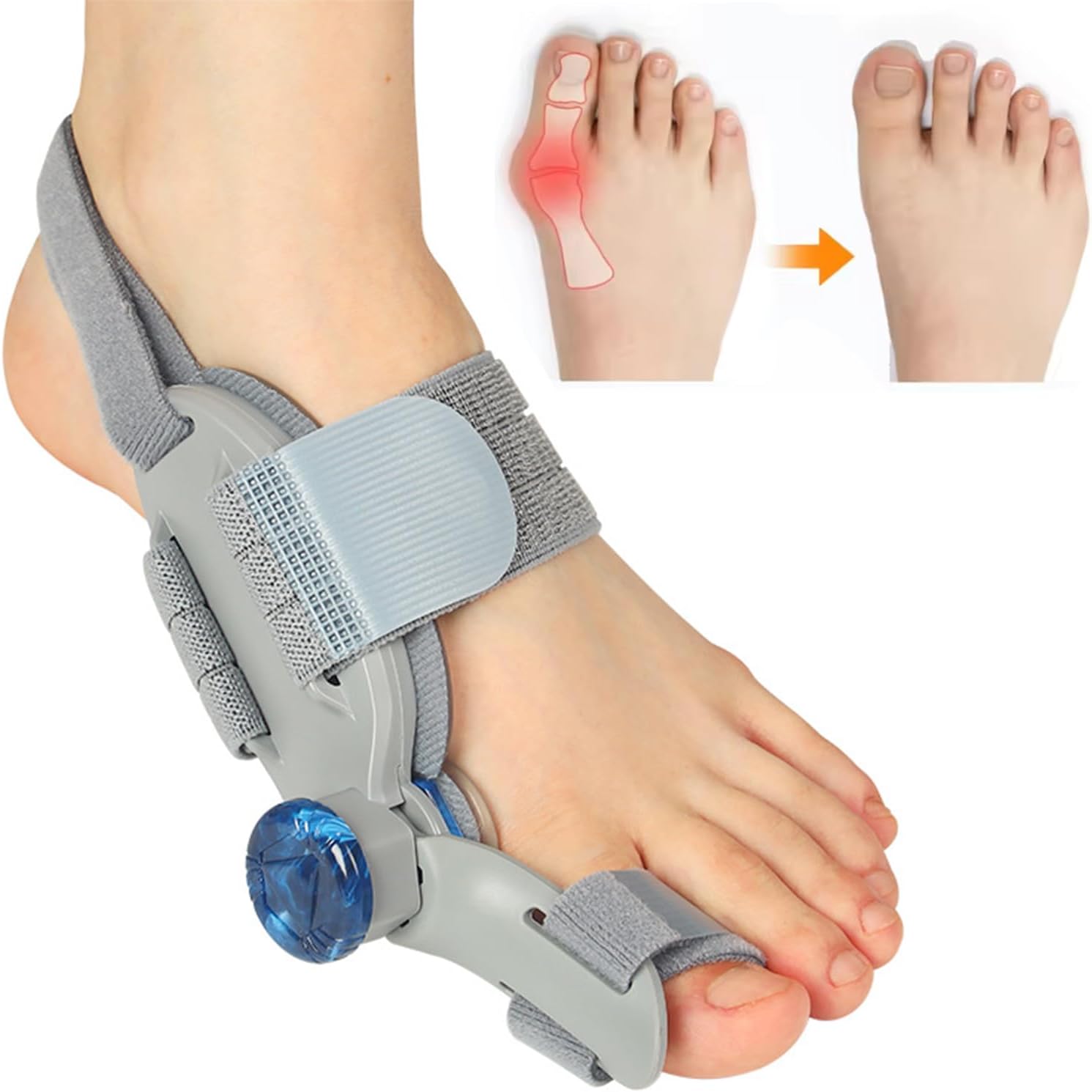 ShrooFit Effective Bunion Corrector for Women and Men | Relieve Pain ...