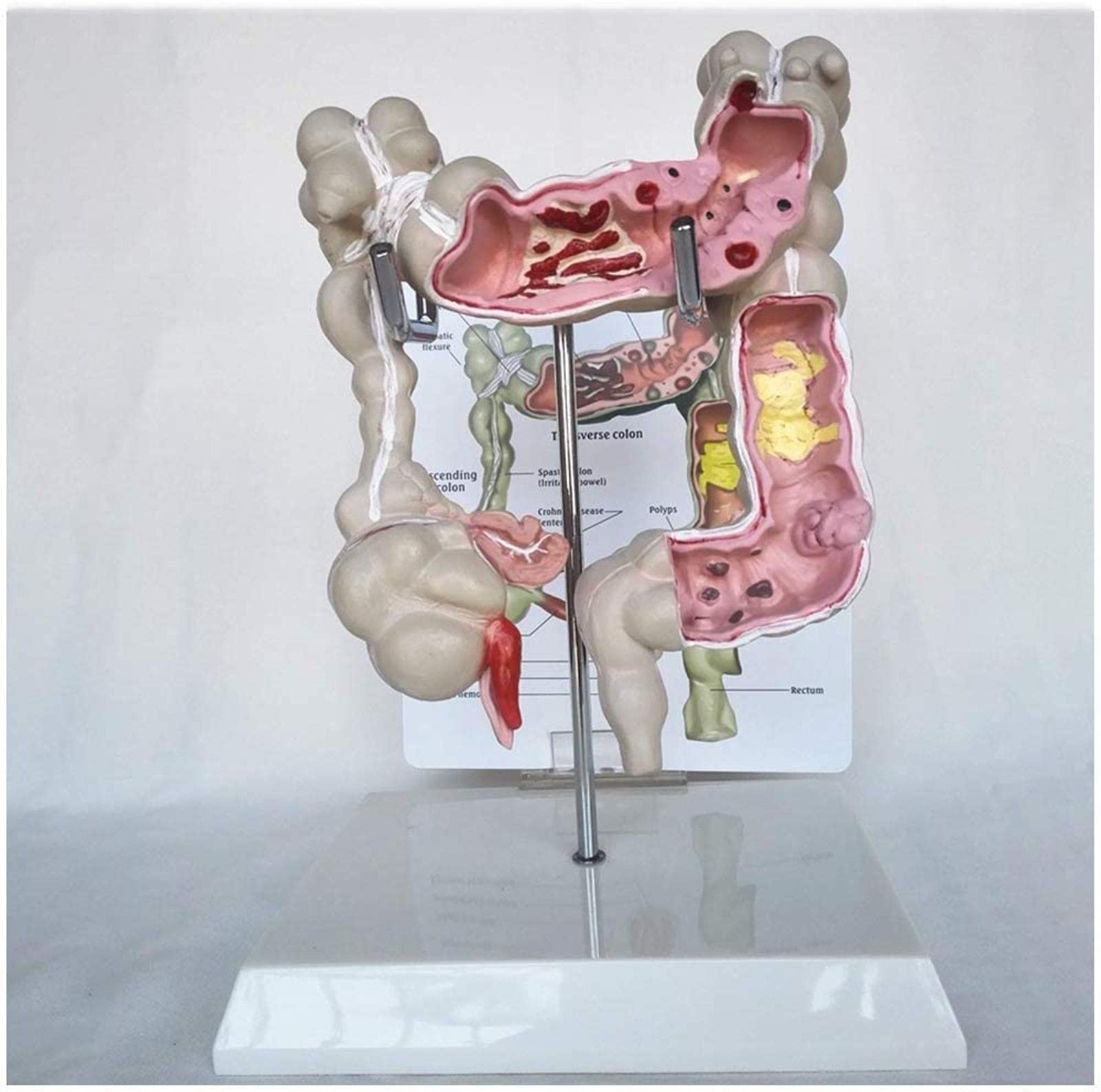 Buy Human Colorectal Disease Educational Model Human Organ Anatomical ...