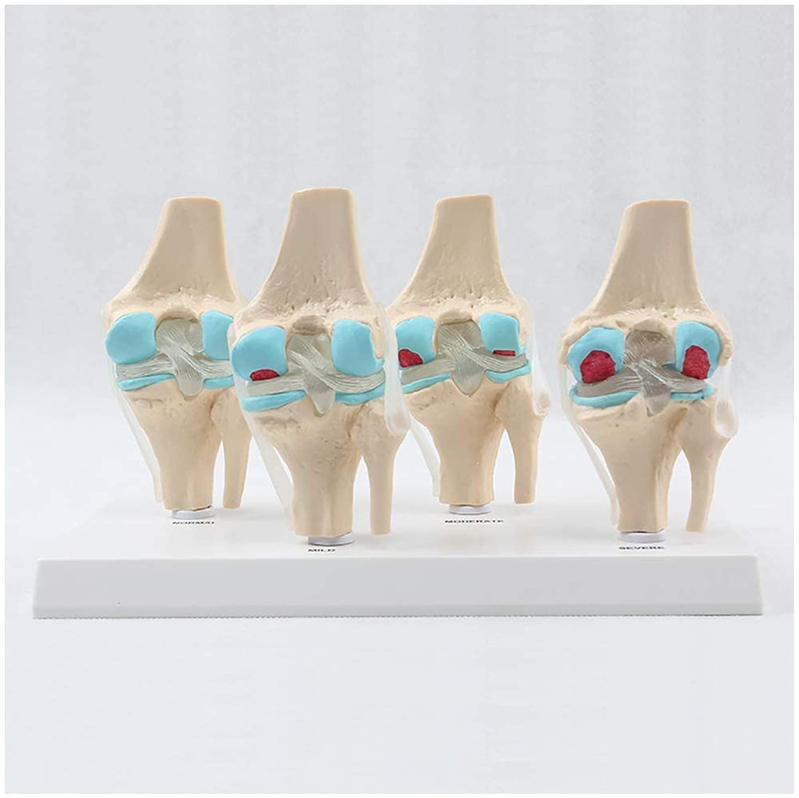 Buy Anatomy Model, 4 Stage Knee Joint Disease Model - Human Knee Model ...