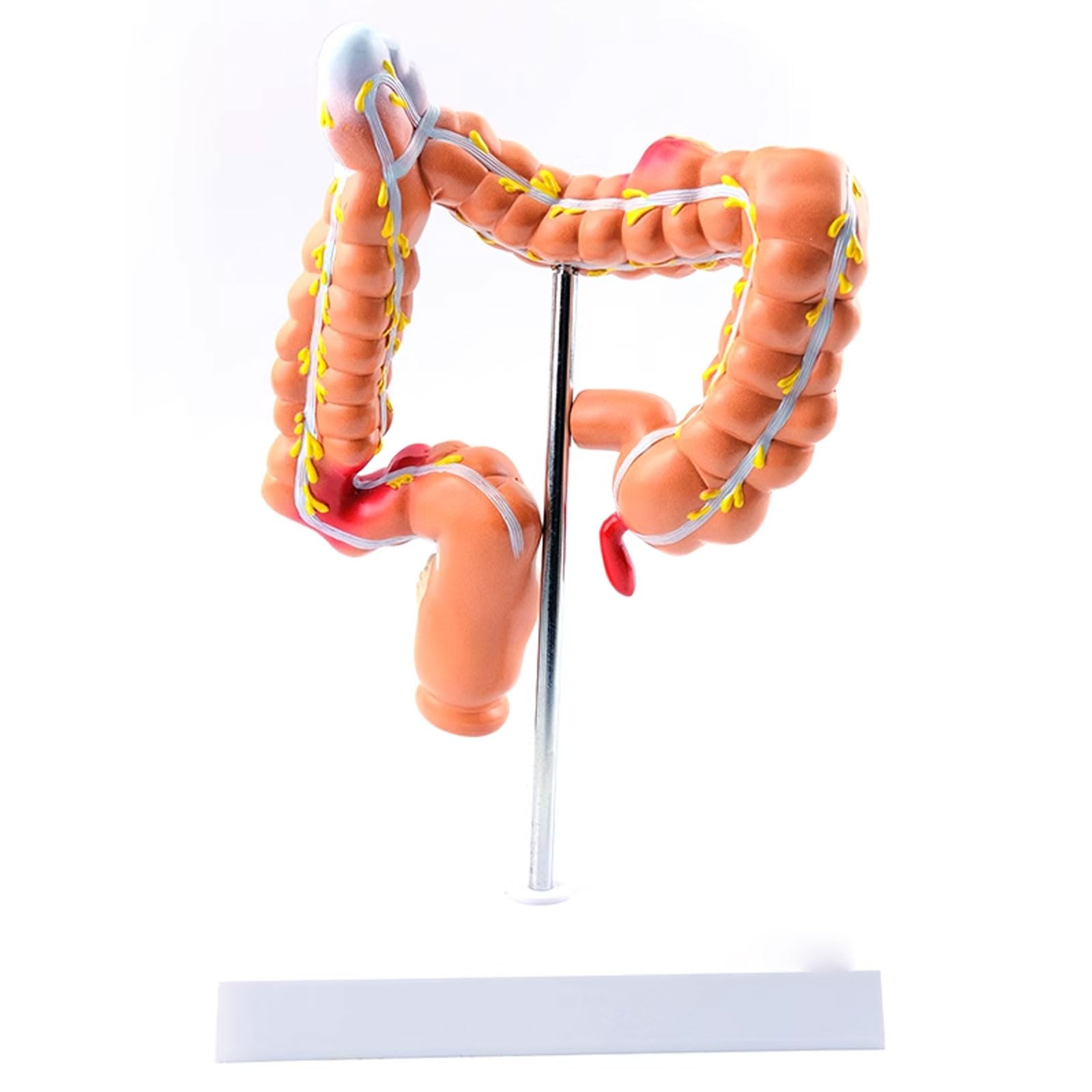 Large Intestine Model With Diseases Anatomystuffcouk Intestinal