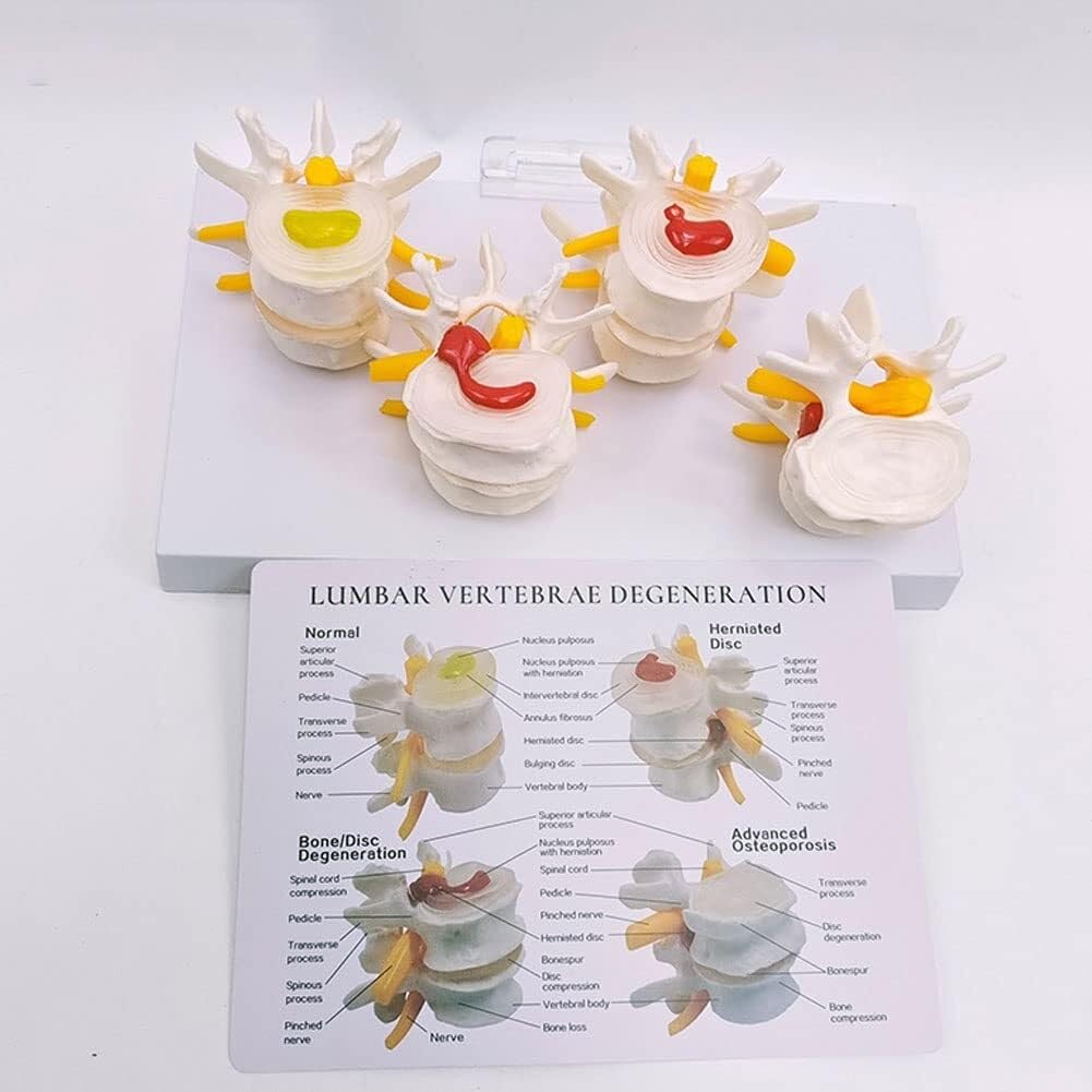 Lumbar Disc Herniation Model Human Lumbar Spine Model With 4 Disease ...