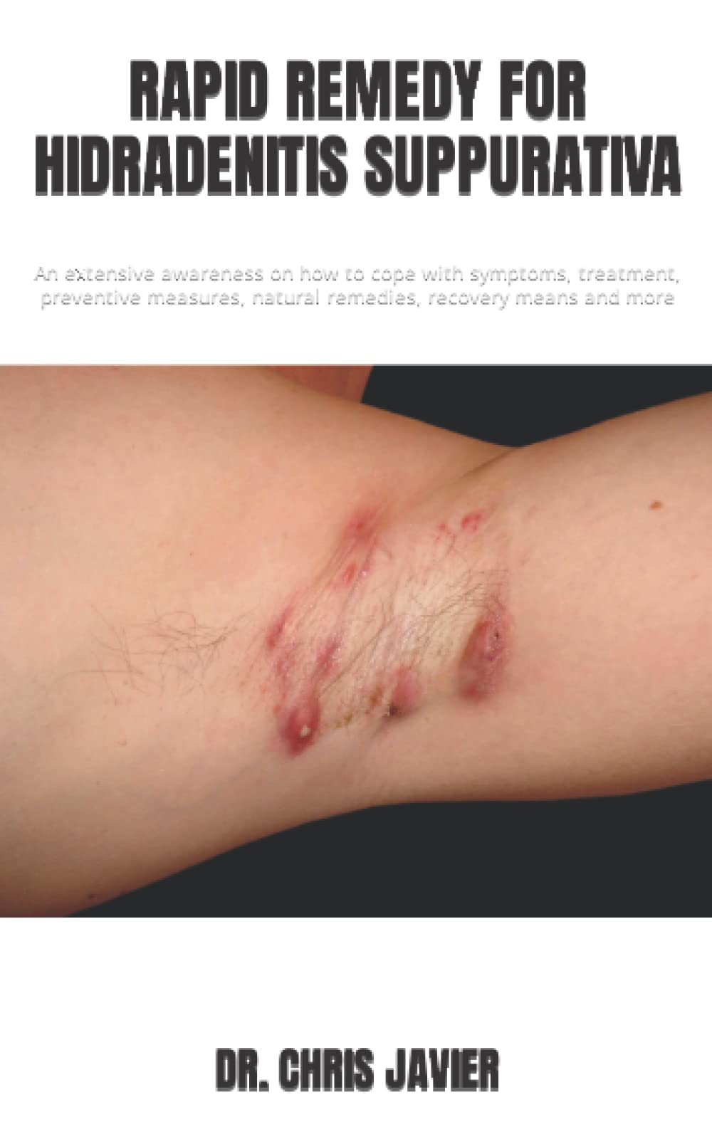 RAPID REMEDY FOR HIDRADENITIS SUPPURATIVA: An extensive awareness on ...