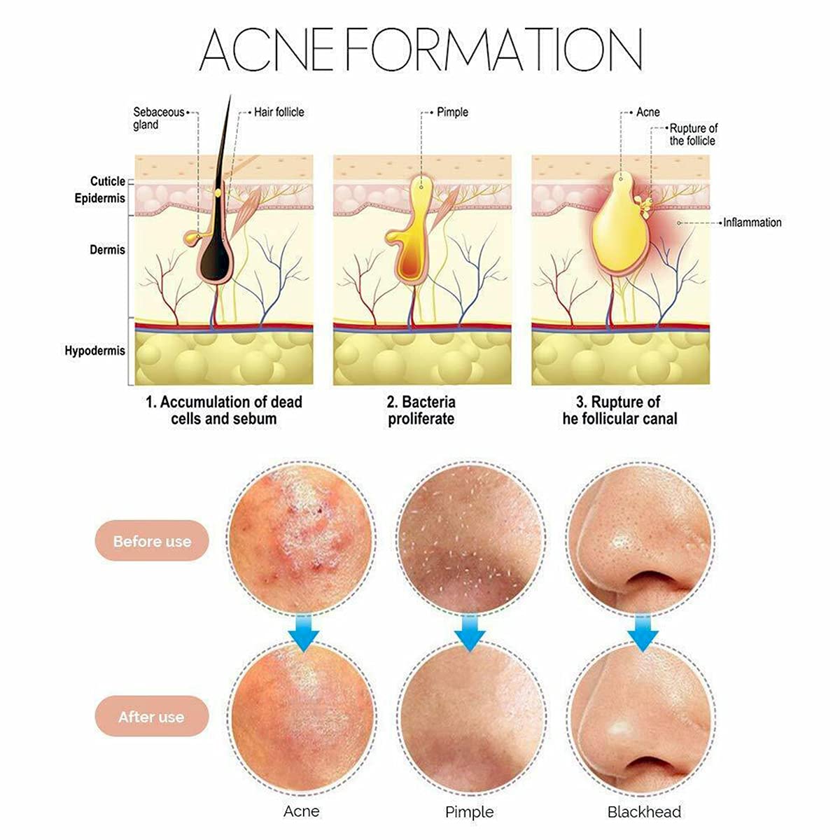 Popping Pimples Diagram How A Pimple Forms | Skin Care For Pimples