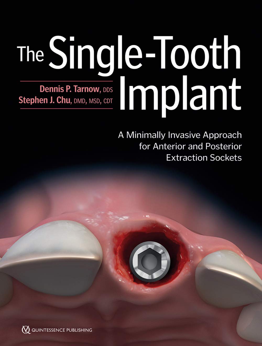 Amazon | The Single-Tooth Implant: A Minimally Invasive Approach for ...