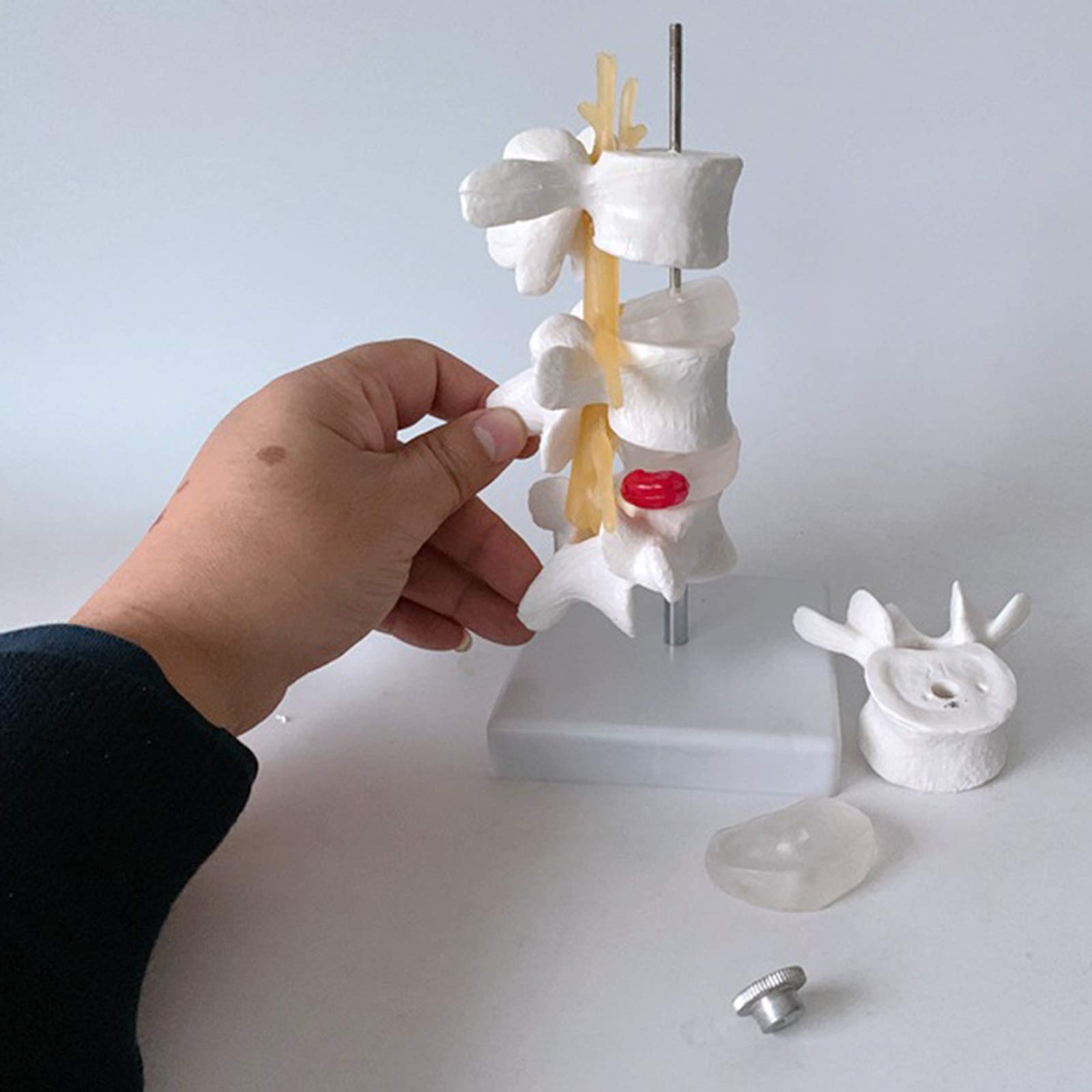 XIEZI Anatomical Model Lumbar Disc Herniation Demonstration Model ...