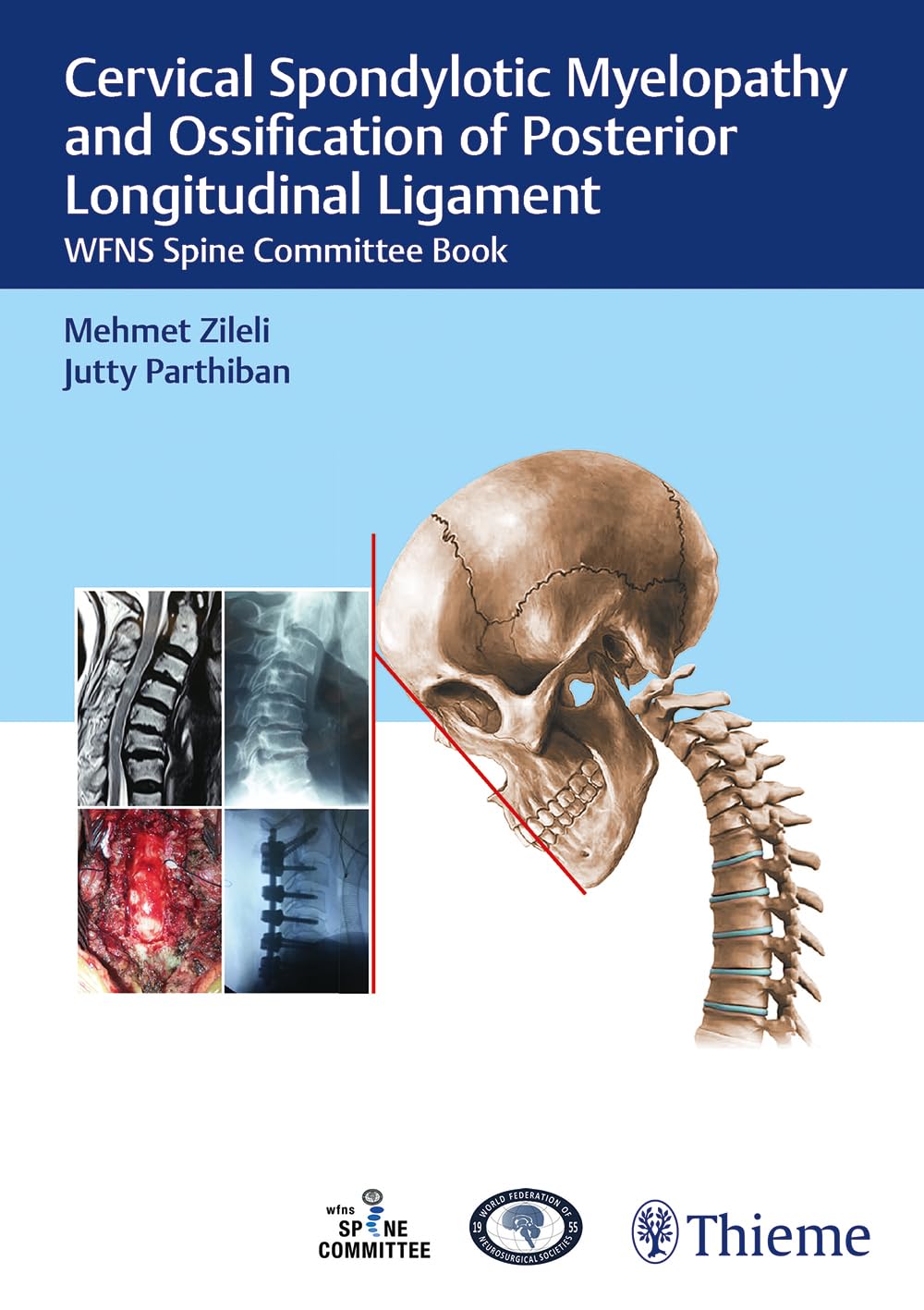 Cervical Spondylotic Myelopathy and Ossification of Posterior ...