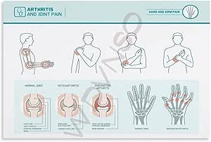 Amazon.com: Arthritis And Joint Pain Poster Health Knowledge Guide (1 ...