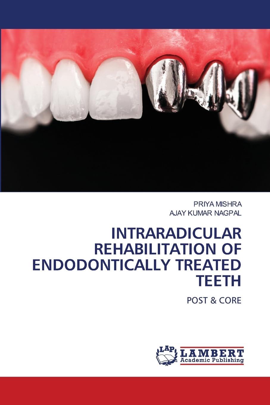 Buy Intraradicular Rehabilitation of Endodontically Treated Teeth Book ...