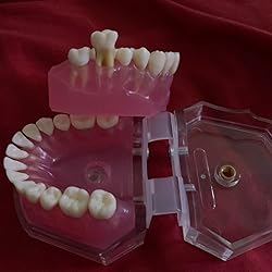 Amazon.com: Dental Implant Teeth Model Study Teach Standard Model with ...