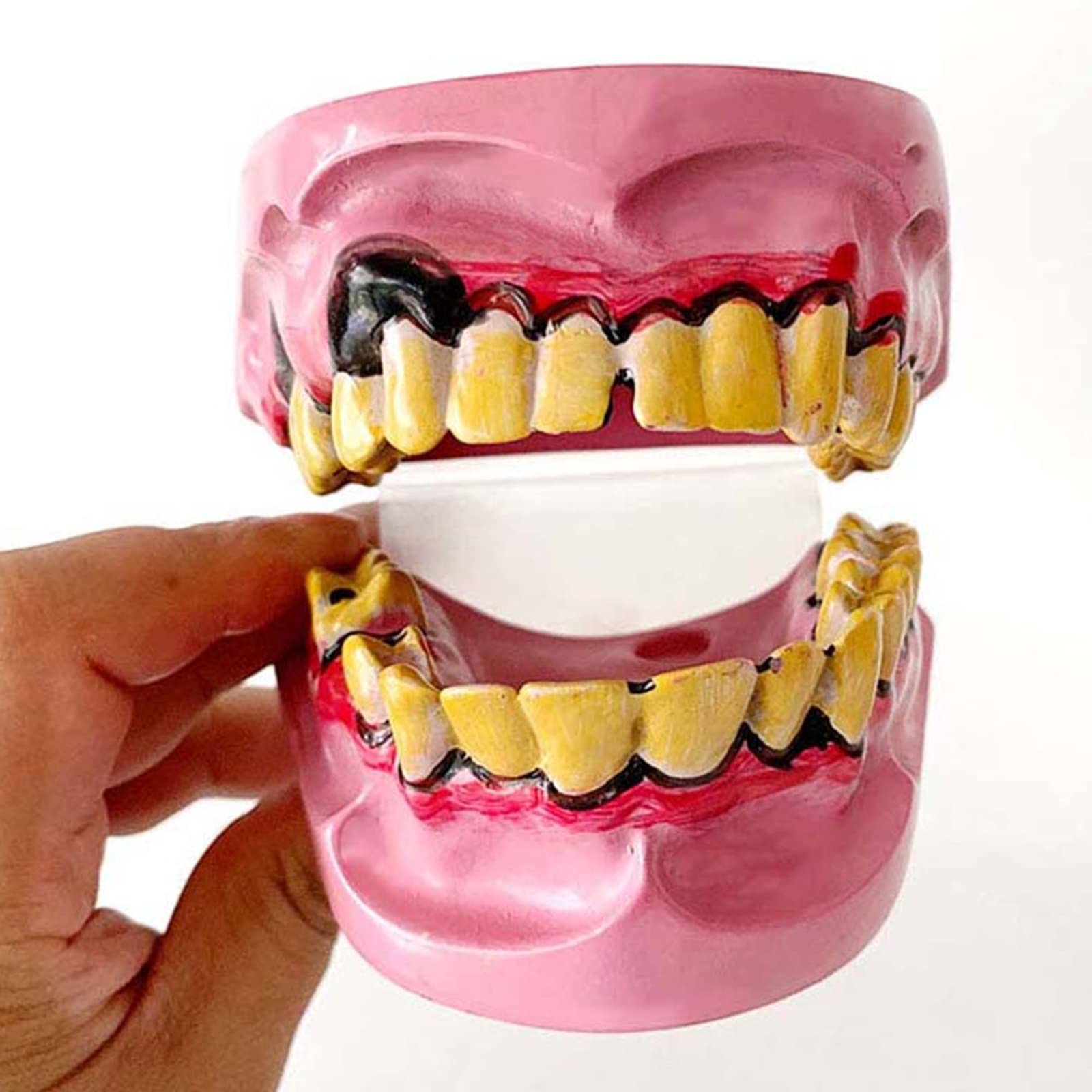 Buy Oral Pathology Model, Human Smoker Diseased Tooth Model, Tooth ...