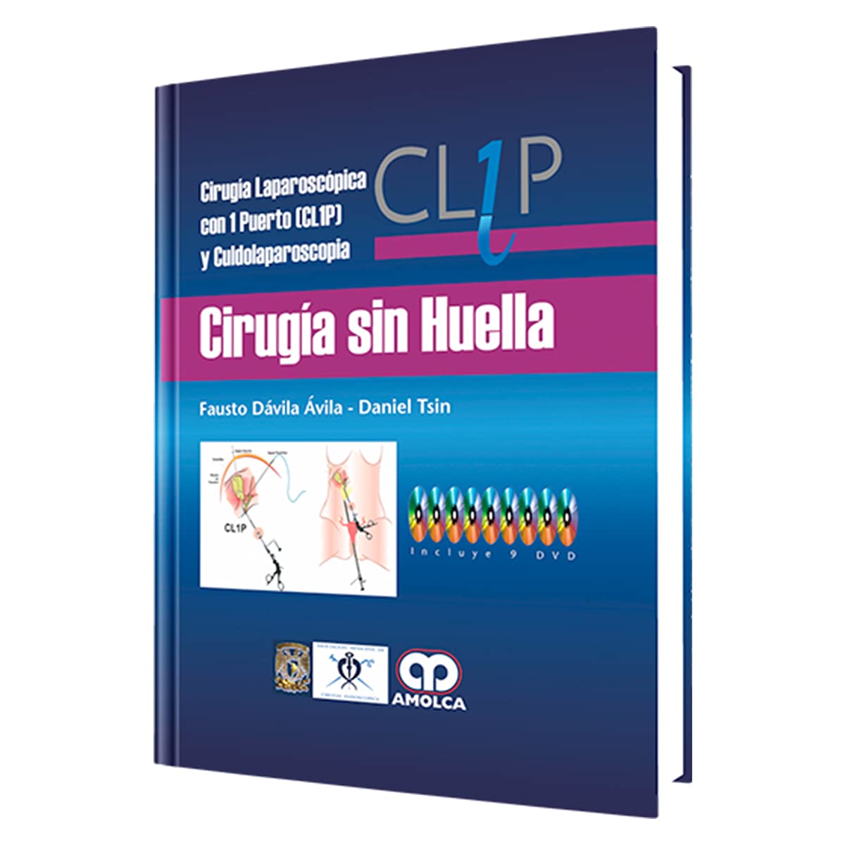 Amazon.com: Cirugía Sin Huella. Cirugía laparoscópica con 1 puerto ...