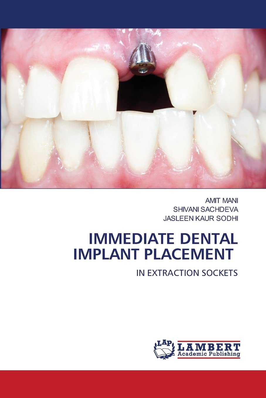 IMMEDIATE DENTAL IMPLANT PLACEMENT: IN EXTRACTION SOCKETS: MANI, AMIT ...