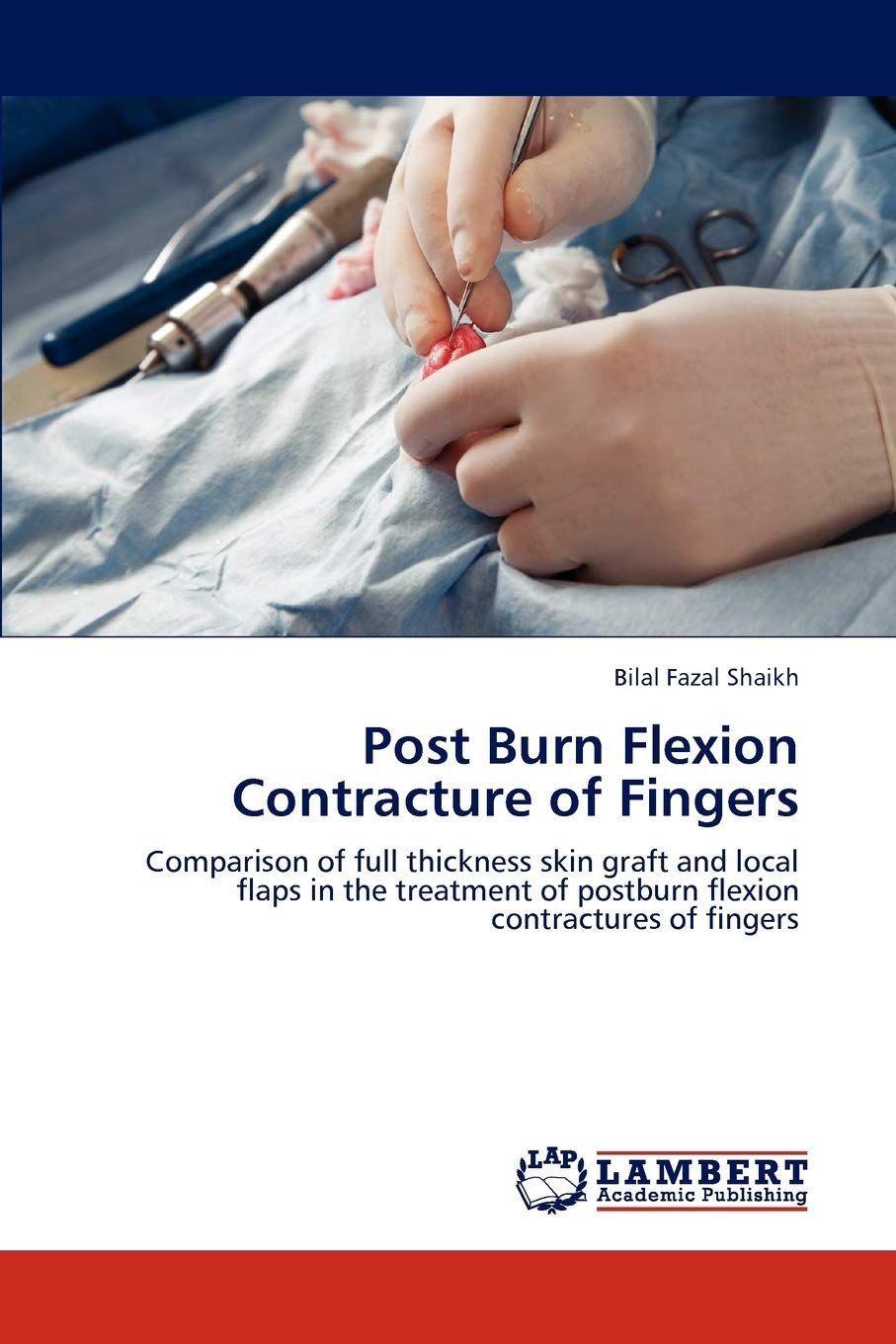 Post Burn Flexion Contracture Of Fingers Comparison Of Full Thickness ...