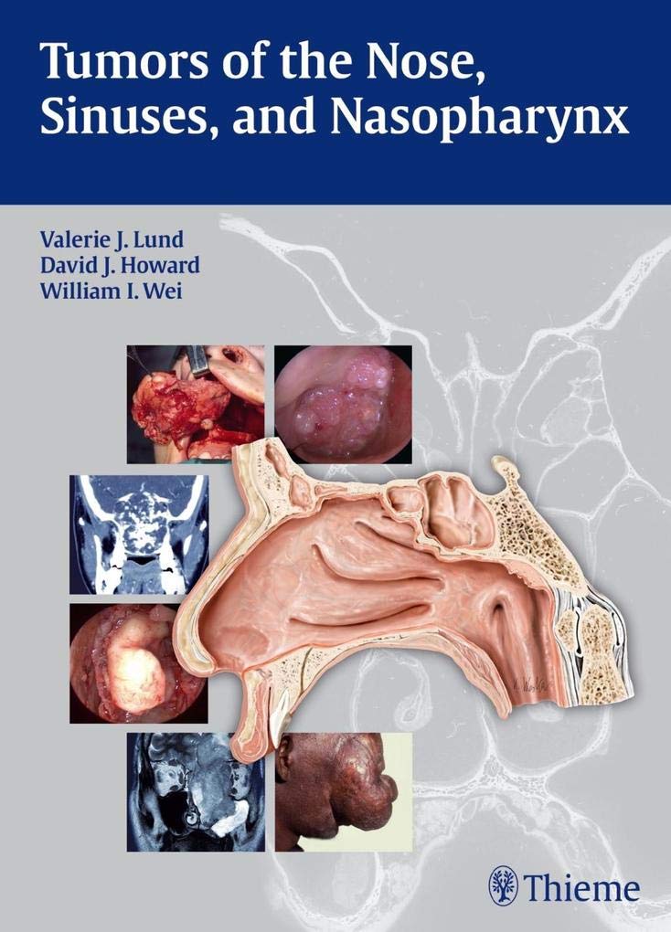 Tumors of the Nose, Sinuses and Nasopharynx: 9783131471918: Medicine ...