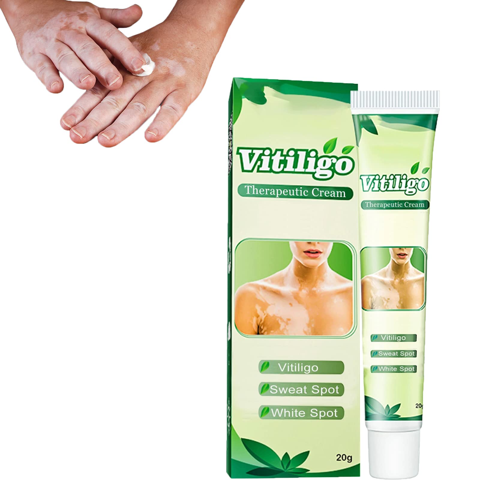 White Tag Treatment Moisturizing Cream Vitiligo Cream Vitiligo Skin ...