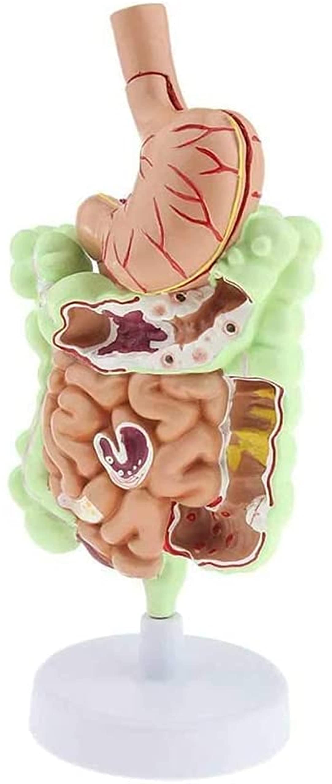 Buy aipipl Study Model Anatomy Pathological Model of Human Colon ...