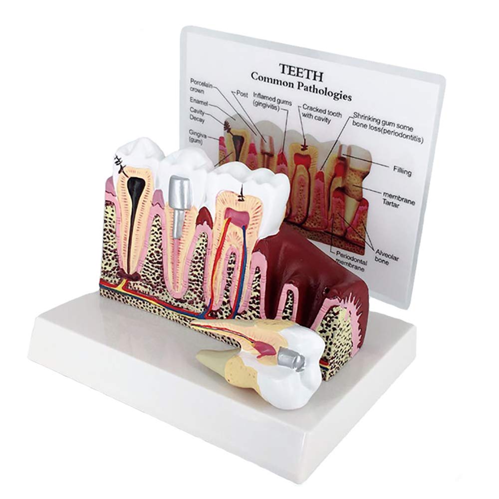 Buy LMEIL Dental Teeth Care Model Removable Tooth Decay Anatomical ...