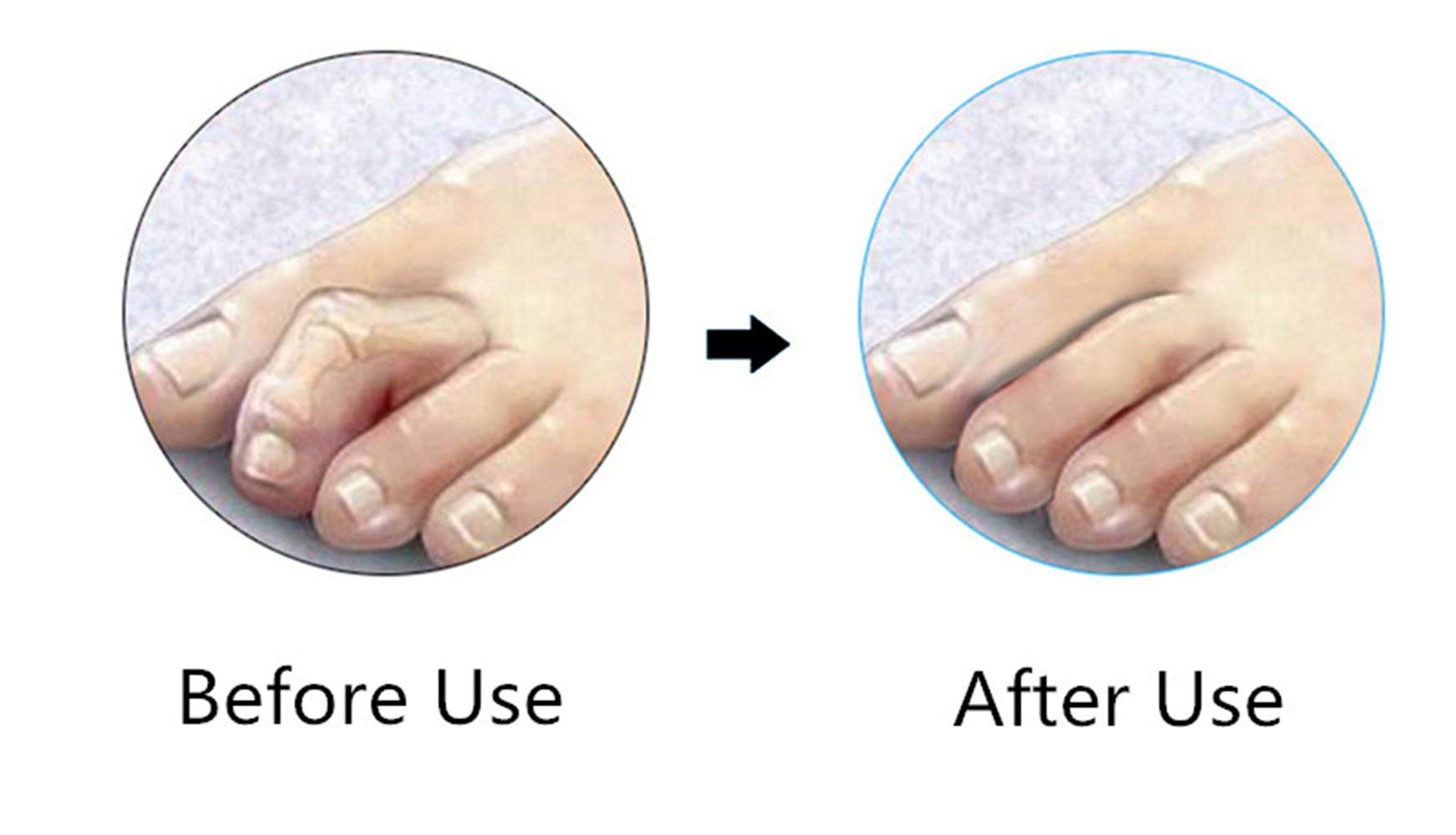 2 Pairs 3 Loop Gel Hammer Toe Pads Cushions & Straigtner by ERGOfoot ...