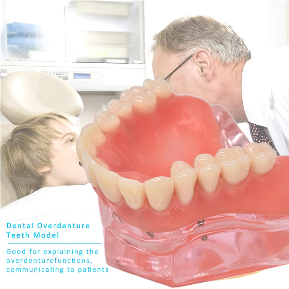 Buy Dental Model Overdenture Inferior Precision Implants Demo Removable ...