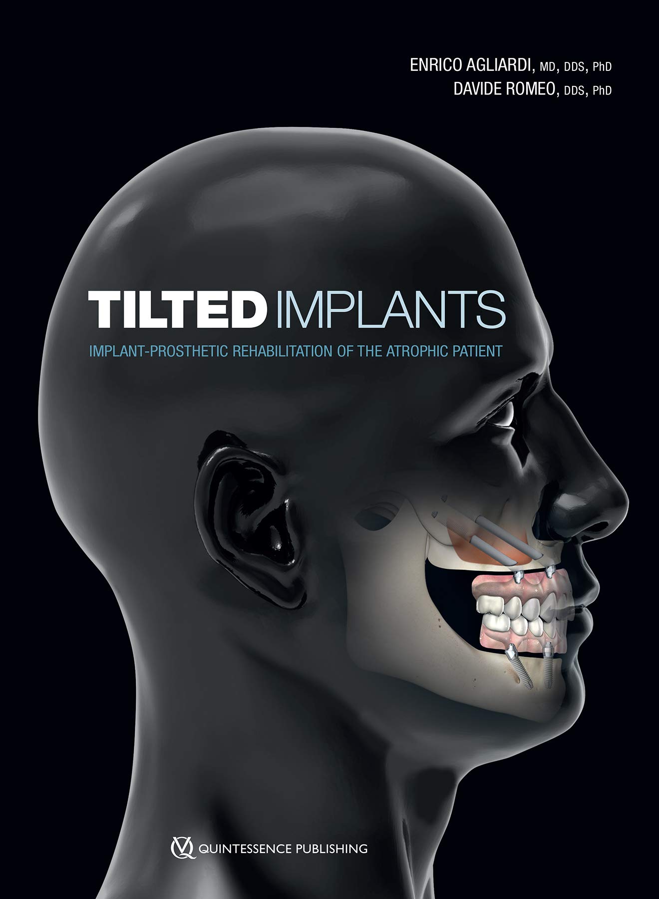 Tilted Implants: Implant-prosthetic Rehabilitation of the Atrophic ...
