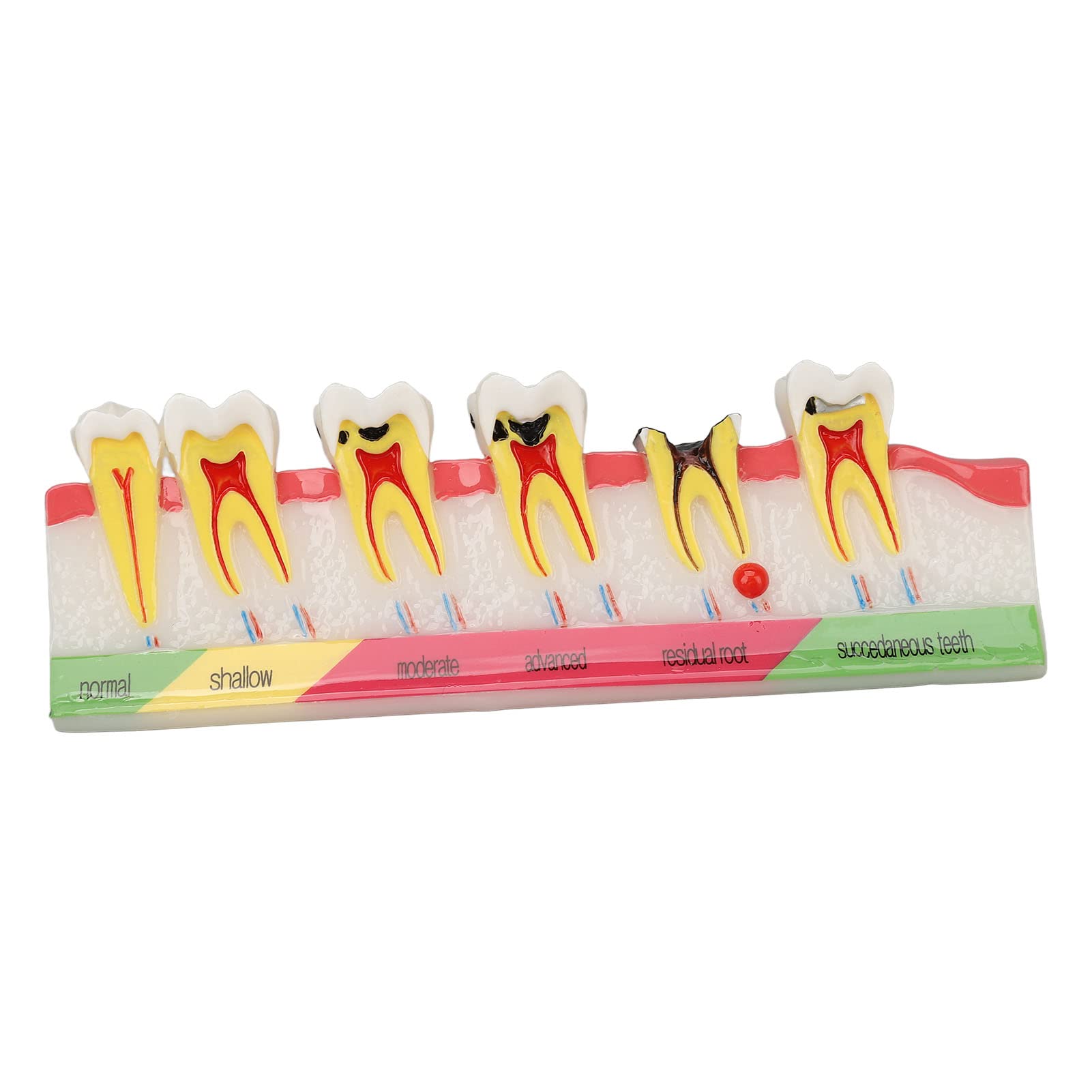 Dental Caries Progression