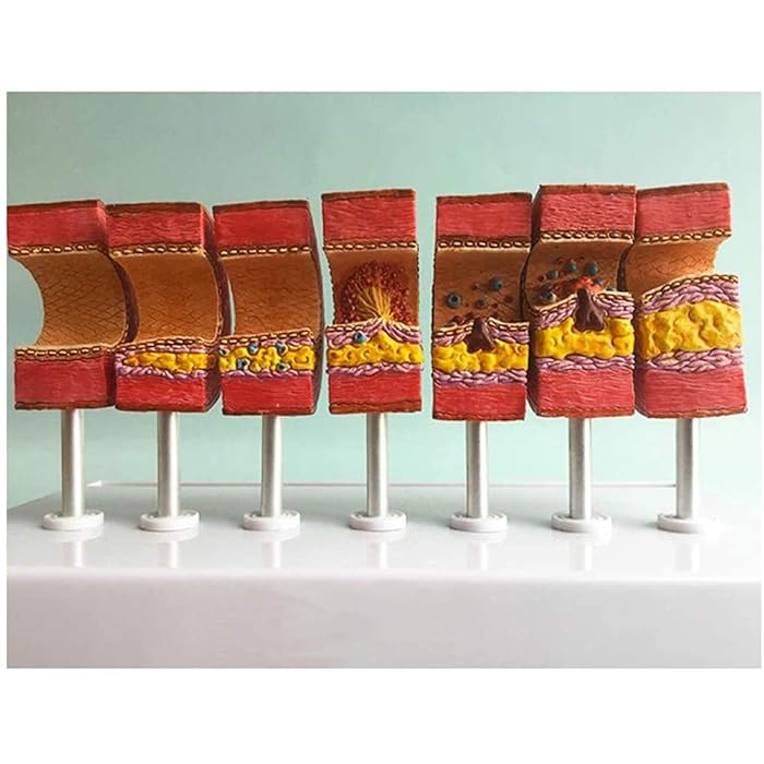 Buy Artery Anatomical Model - Anatomical Vessel Atherosclerosis ...