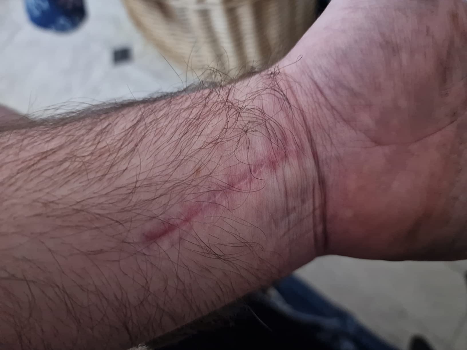 Scar Gone Scar Minimising Massager Works to Improve and Repair Both New ...