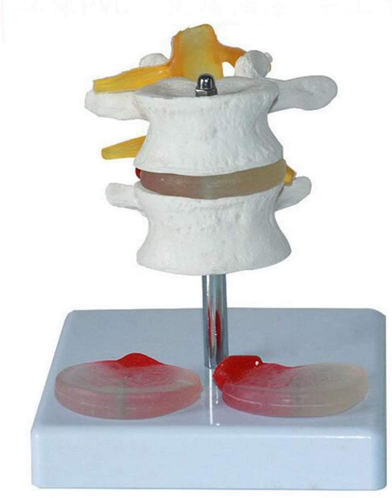 Lumbar Disc Herniation Model Two Segment Lumbar Anatomical Model Lumbar ...