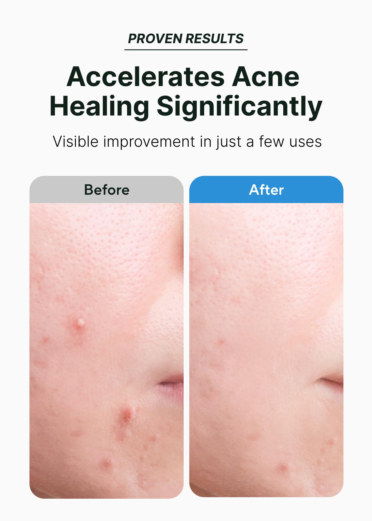 Snapklik.com : Easyderm 2-in-1 Dual-Tip Pimple Popper Tool Perfect Acne ...