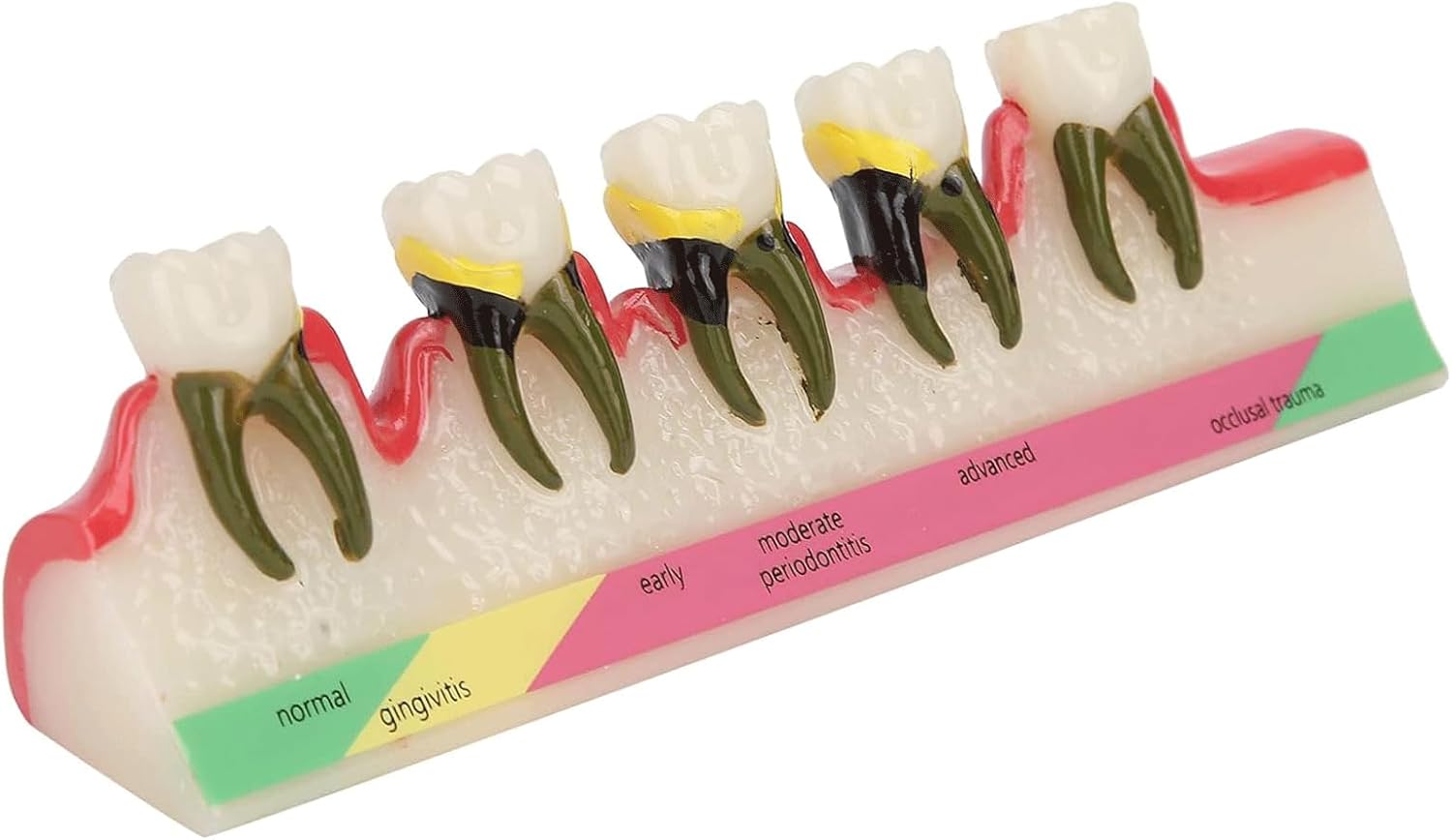 Amazon.com: FROON Dental Mouth Model Gums Anatomy Model Tooth Evolution ...