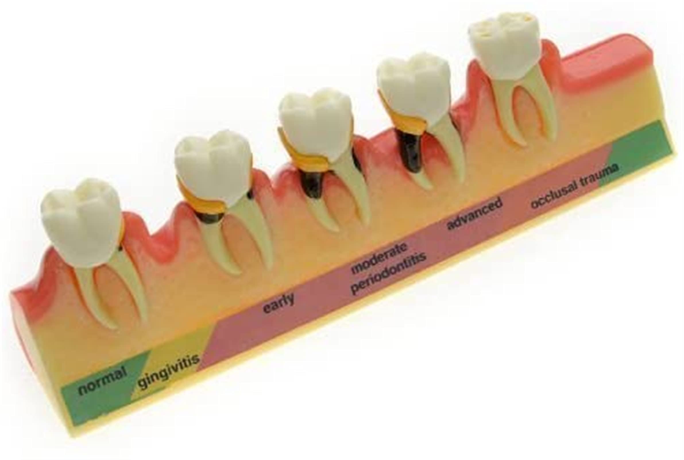 Buy Shu Risiko Body Model Periodontal Disease Tooth Assorted Typodont ...