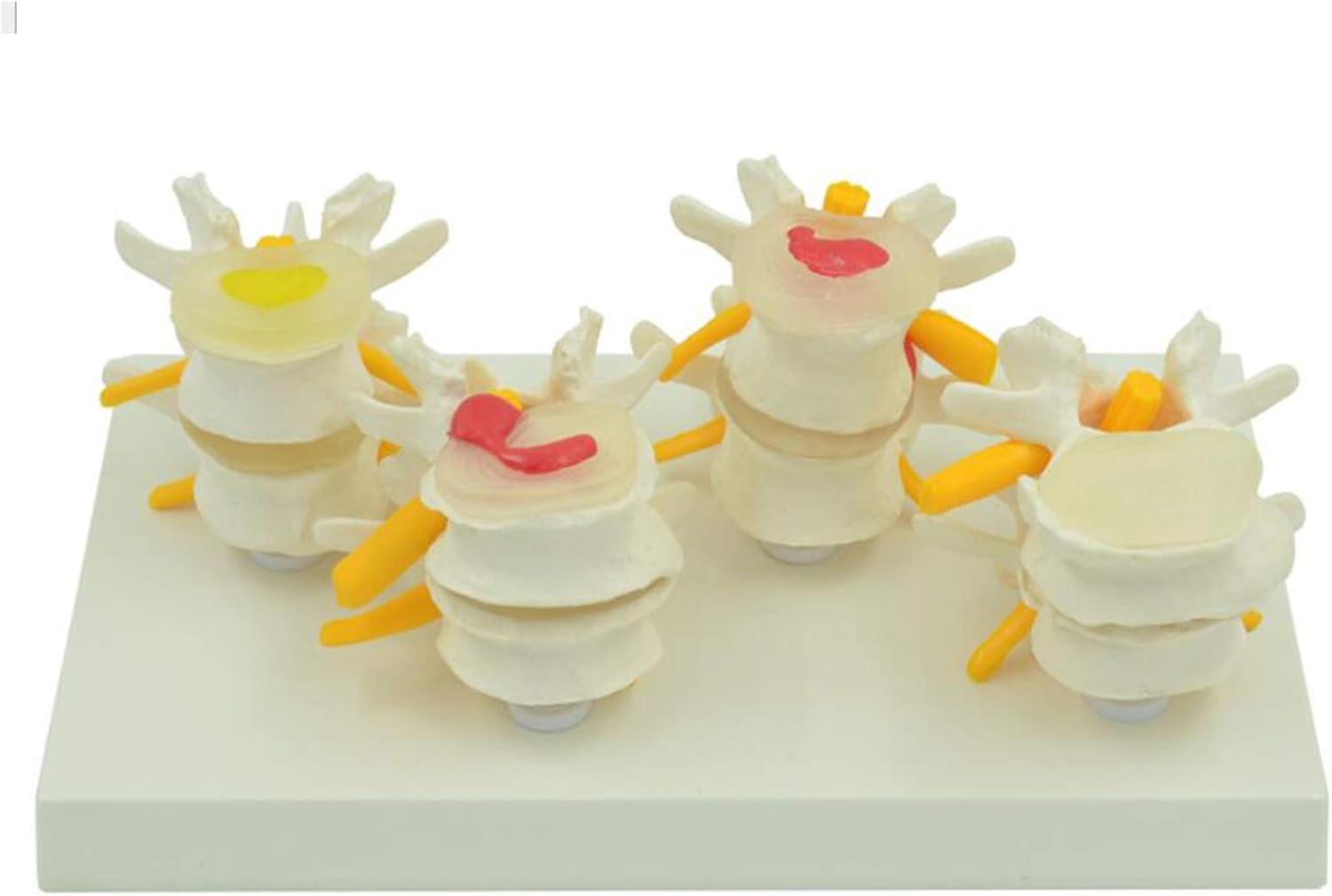4-Stage Lumbar Vertebrae Spine Model - Human Spine Model - Medical ...
