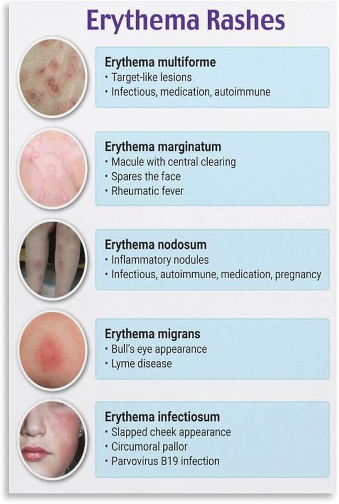 Erythema Migrans Vs Erythema Multiforme