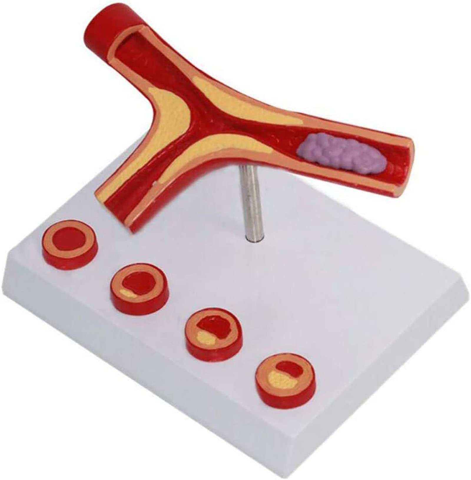 Arteriosclerosis Model Cardiovascular Coronary Artery Arterial ...