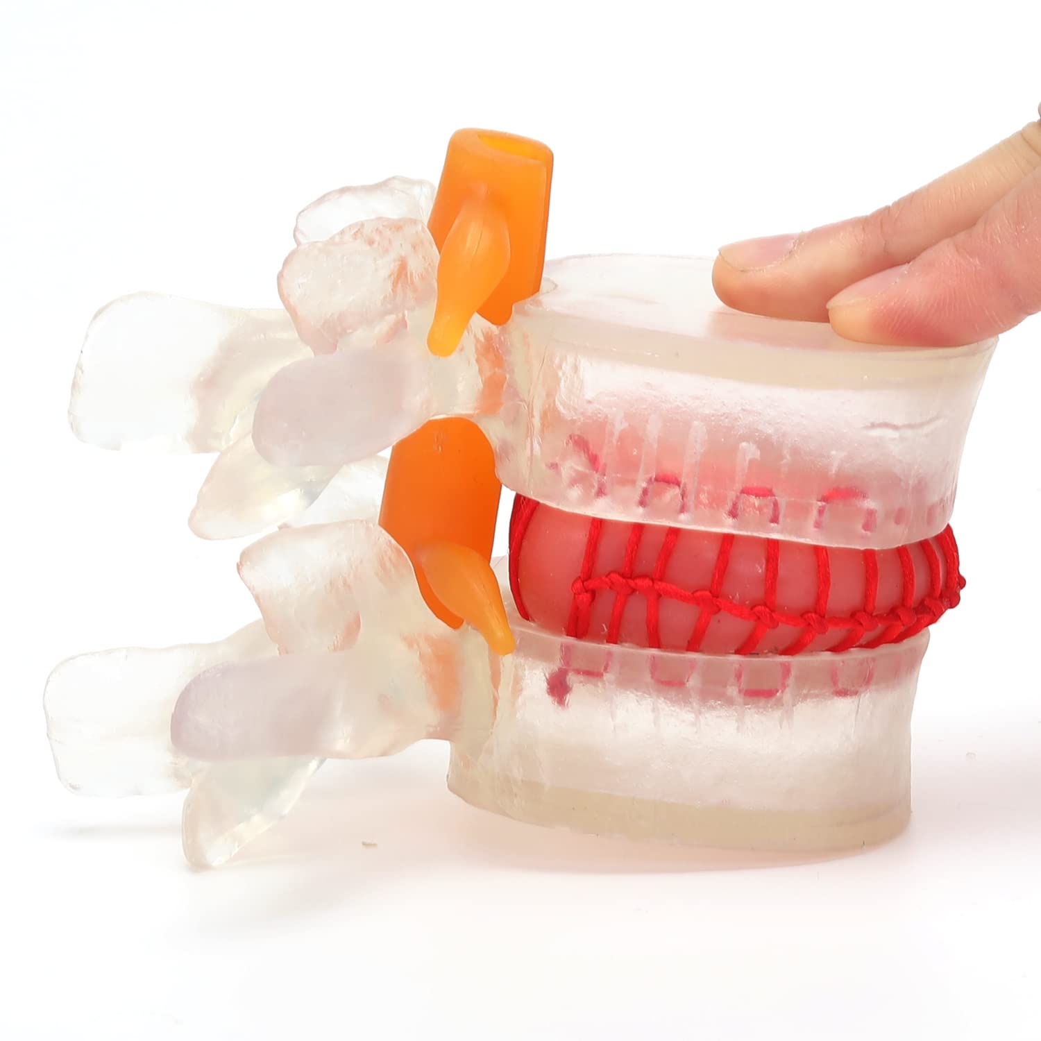 Snapklik.com : MIIRR Human Lumbar Disc Herniation Model, Transparent ...