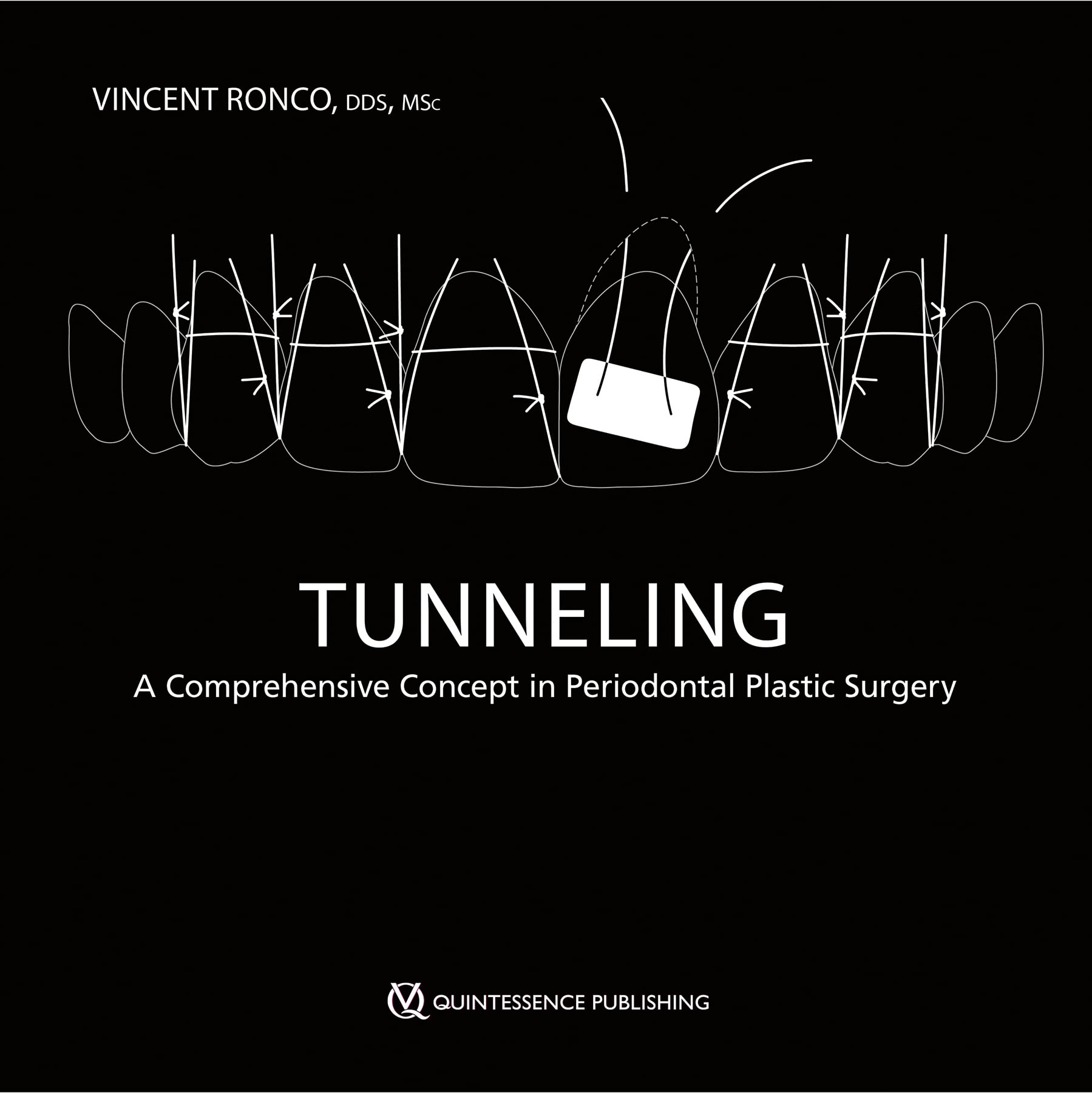 Amazon | Tunneling: A Comprehensive Concept in Periodontal Plastic ...