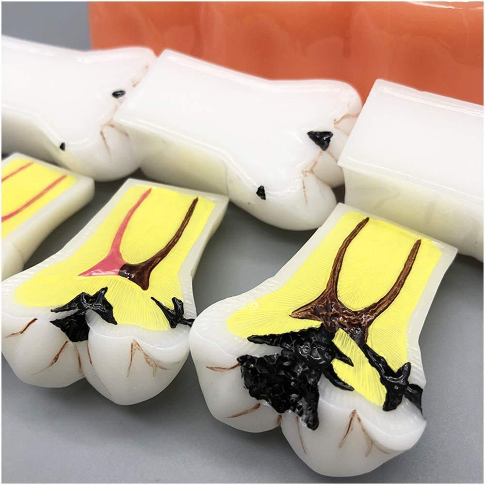 Teeth Practice MediTrainer Teeth Model,4X Periodontal Disease Tooth ...