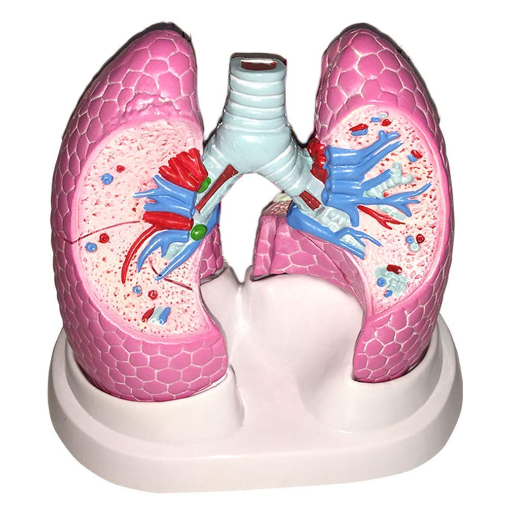 Xyxz Anatomy Models Lung Model Human Bronchopulmonary Pathology Model ...