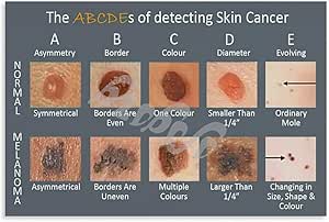 Amazon.com: Skin Cancer Posters Dermatology Education Chart (2) Canvas ...