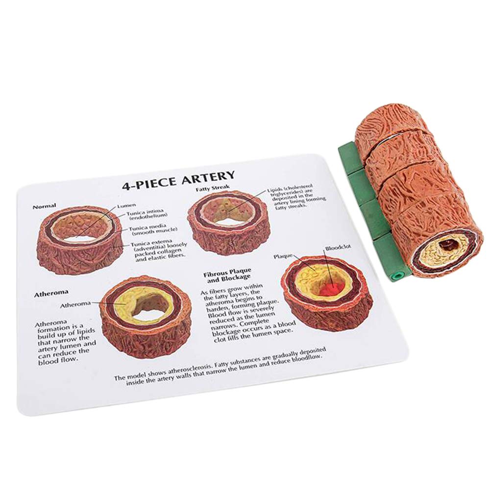Buy LUCKFY Atherosclerosis Model - 4-Piece Artery Model - Human Body ...