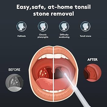 Tonsil Crypts Stones