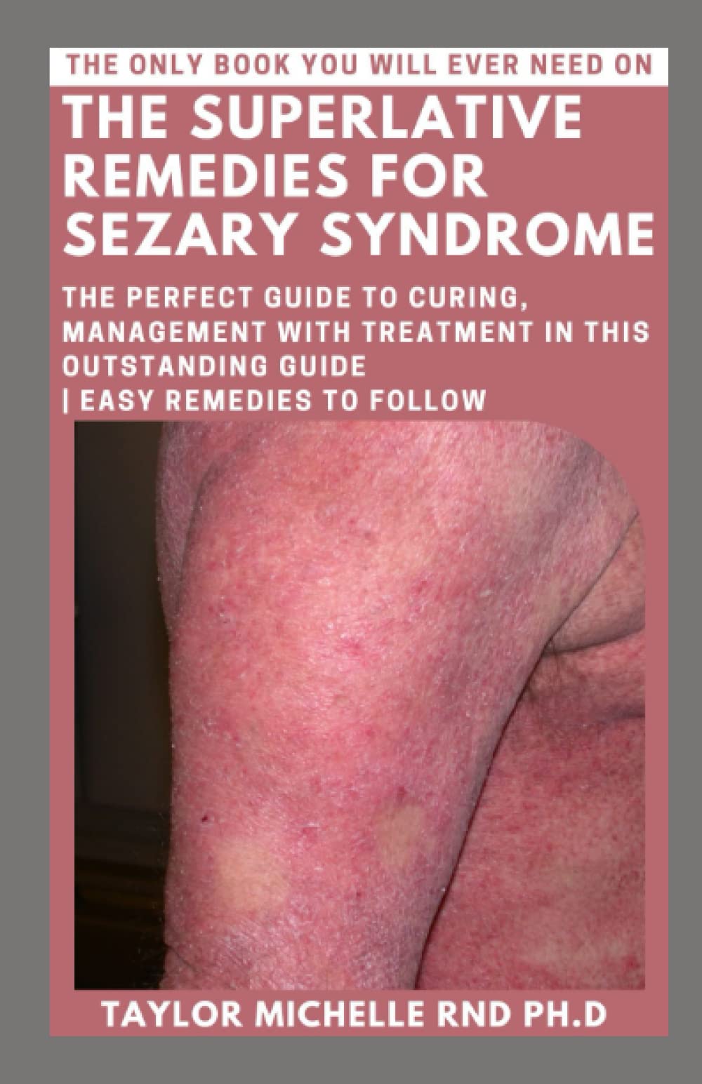 The Superlative Remedies For Sezary Syndrome The Perfect Guide To ...