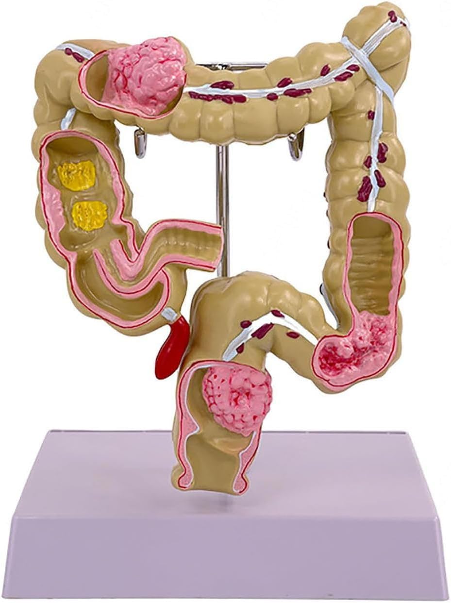 Human Large Intestine Anatomical Model Visceral Lesion Model, Colon ...
