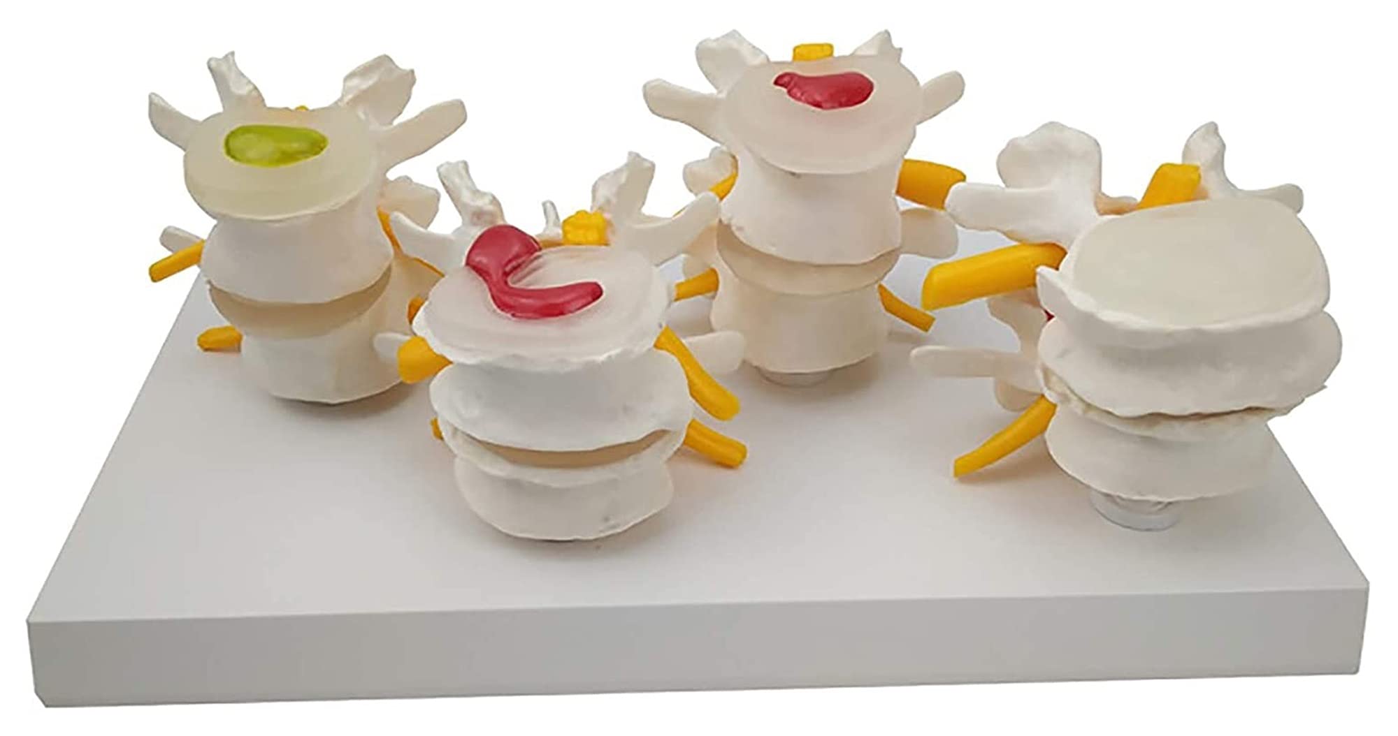Study Model Spine Lumbar Disc Herniation Model Human Lumbar Vertebral ...
