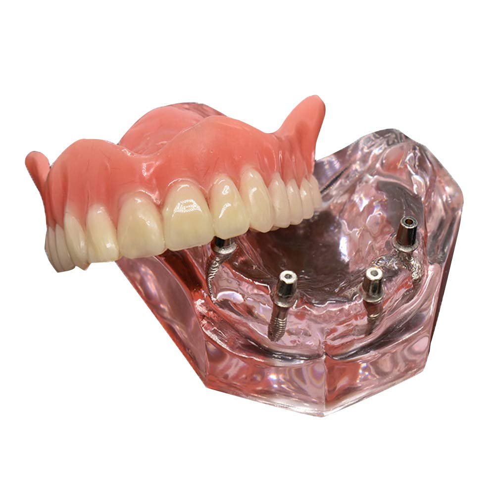 Buy Dental Model Overdenture Inferior Precision Ims Demo Removable ...